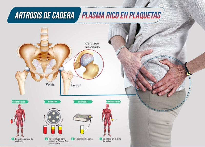 Artrosis de Cadera - AYACUCHO